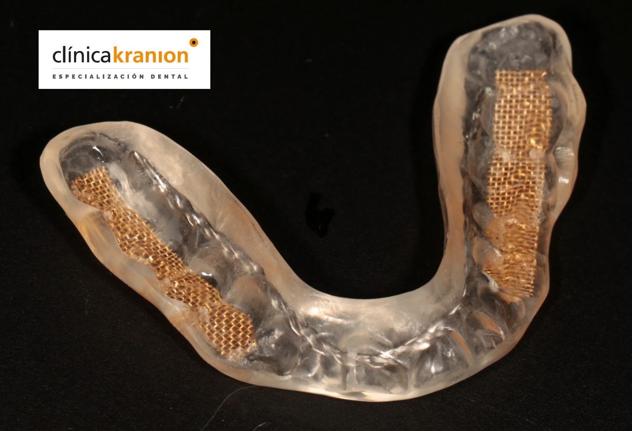 férula bruxismo (experiencias y recomendaciones) - Forocoches