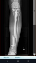 Fractura tibia mal consolidada +temaserio - Forocoches